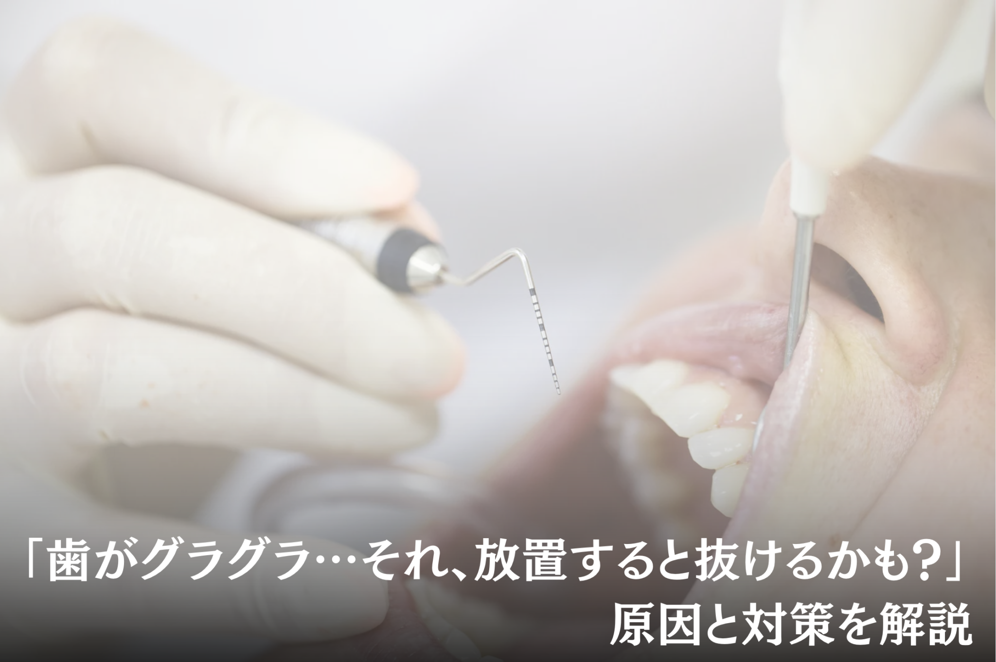 「歯がグラグラ…それ、放置すると抜けるかも？」原因と対策を解説 | LION歯科・矯正歯科